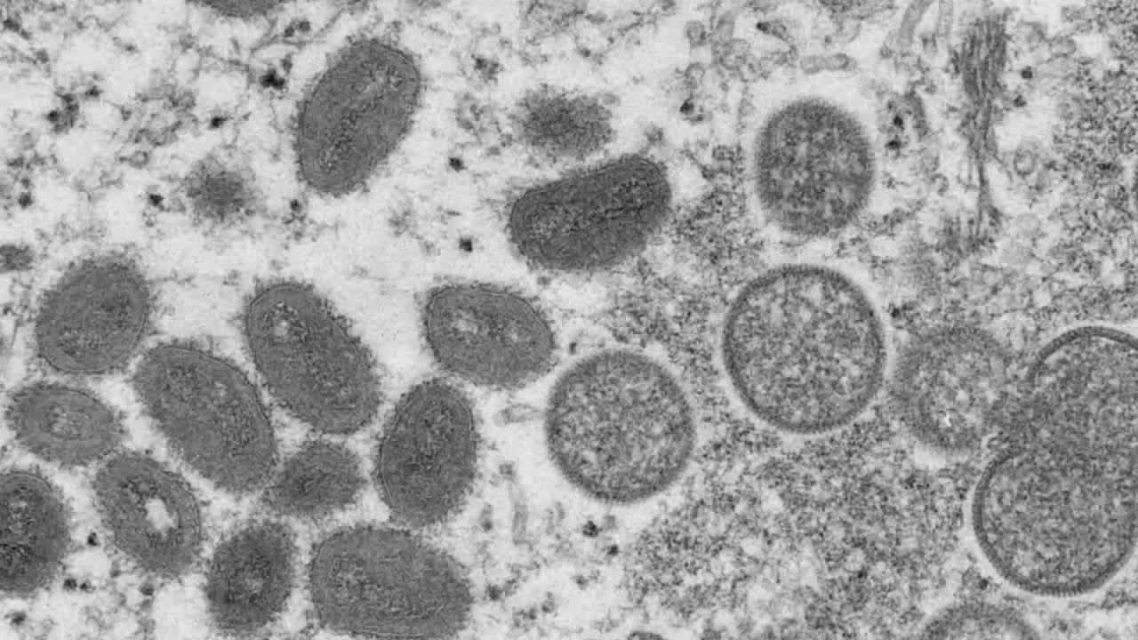 Georgia reports first case of monkeypox in adult woman | FOX 5 Atlanta Georgia reports first case of monkeypox in adult woman | FOX 5 Atlanta