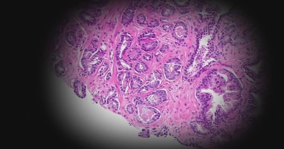 Prostate cancer early screening, highlighted by Dexter King's fight ...