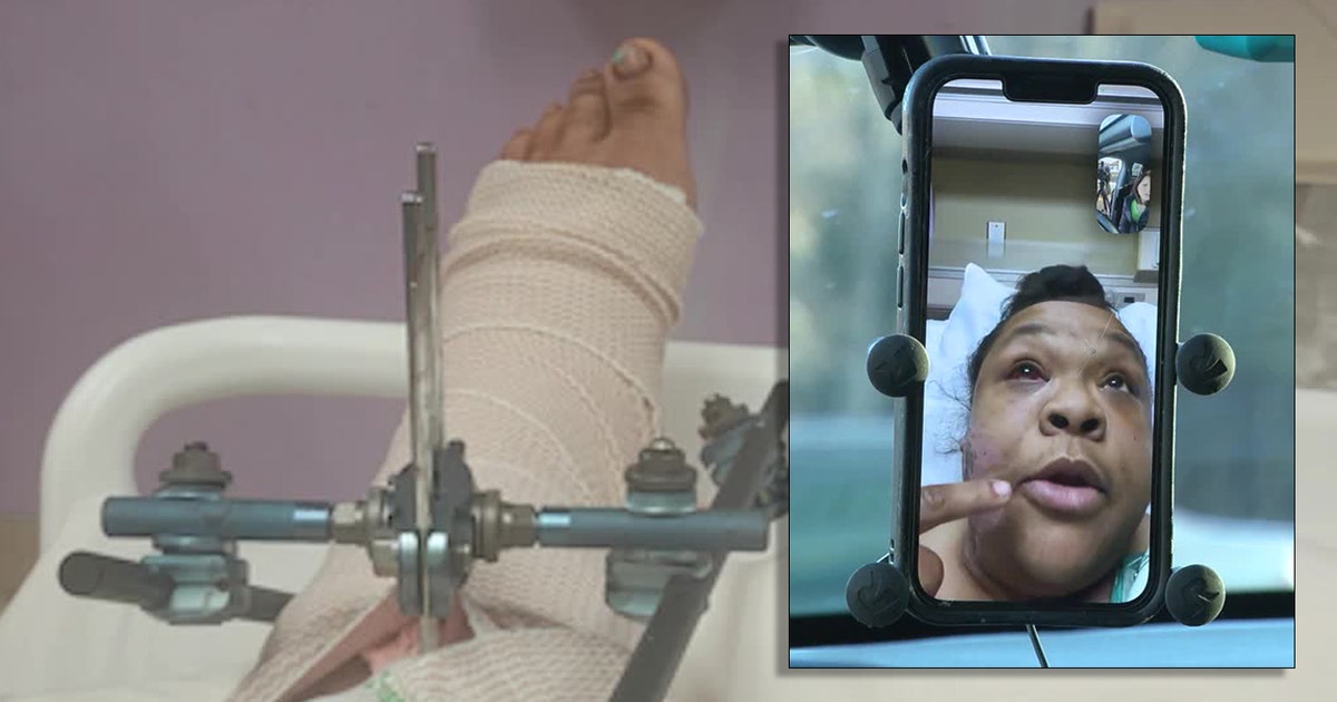 Cobb woman faces long recovery after being run over at gas station ...