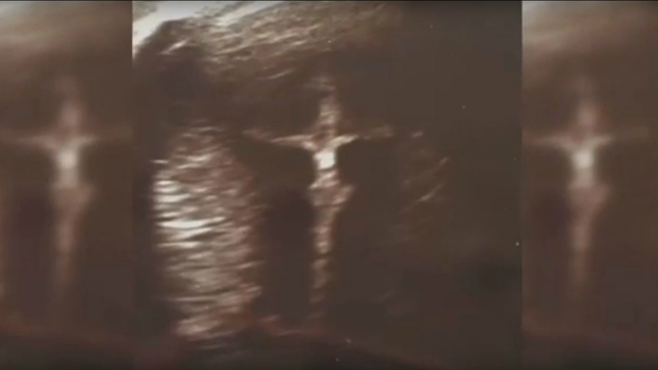 'Divine' sonogram appears to show Jesus on the cross | FOX 5 DC