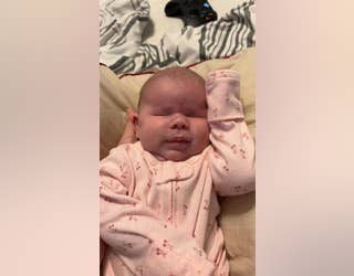 born without eyelids