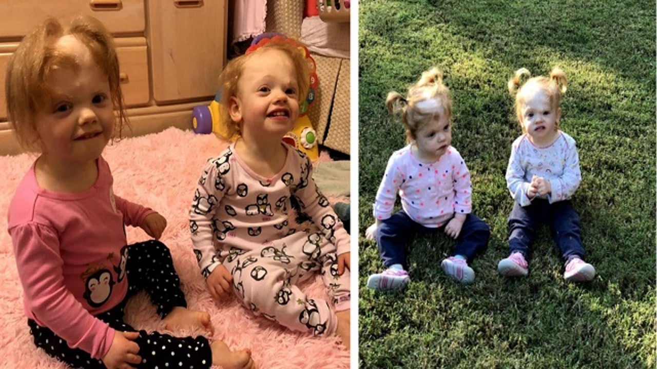 Formerly Conjoined Twins Thriving After Successful Chop Surgery Fox 5