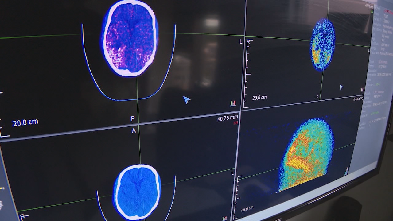 How to spot age-related memory loss