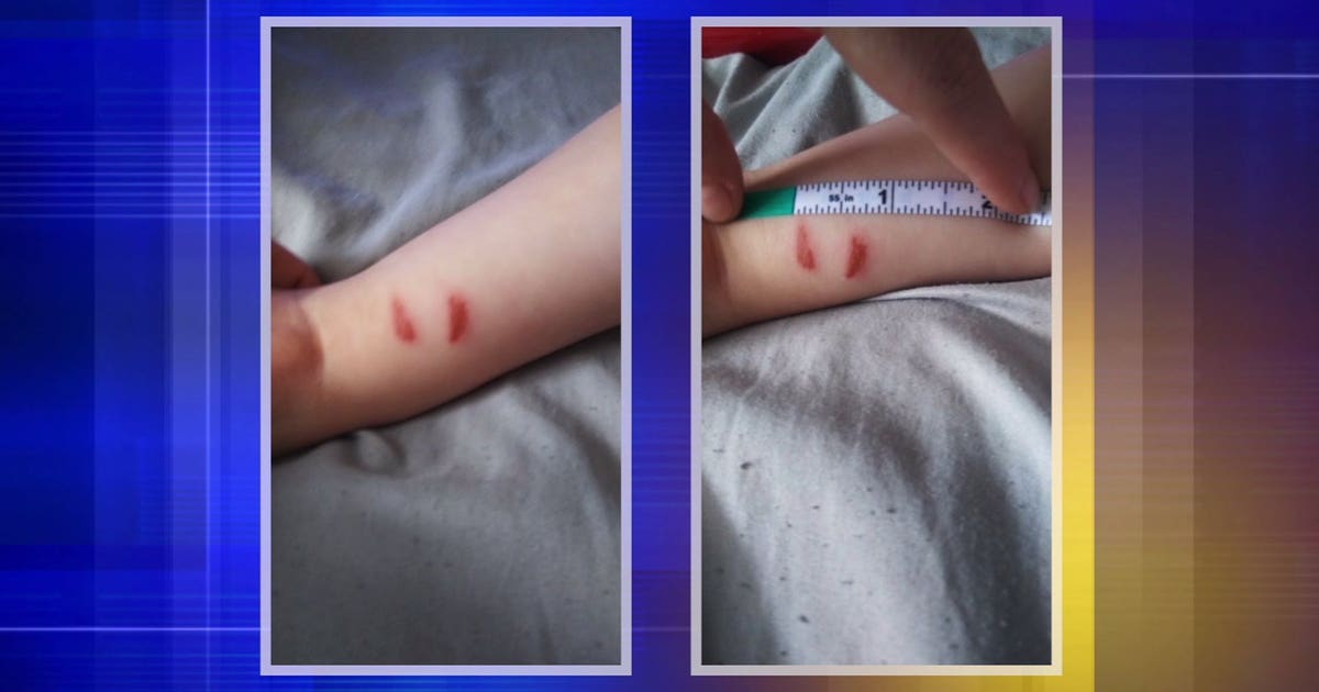 4-year-old boy comes home from school with gashes on wrist, mom says ...