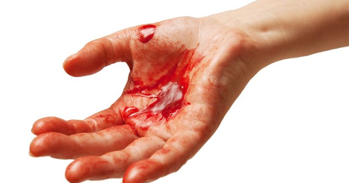 Woman can't stop sweating blood from face and hands, Italian doctor ...