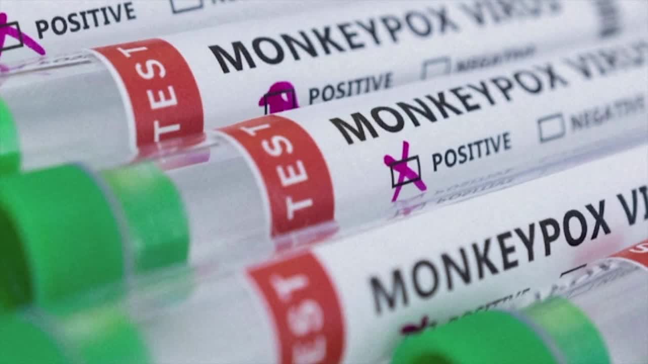 Milwaukee positive mpox case identified, health officials say | FOX6 ...