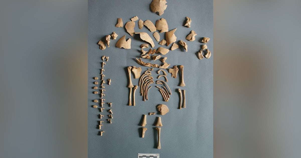 Down syndrome identified in prehistoric bones of infants through DNA ...