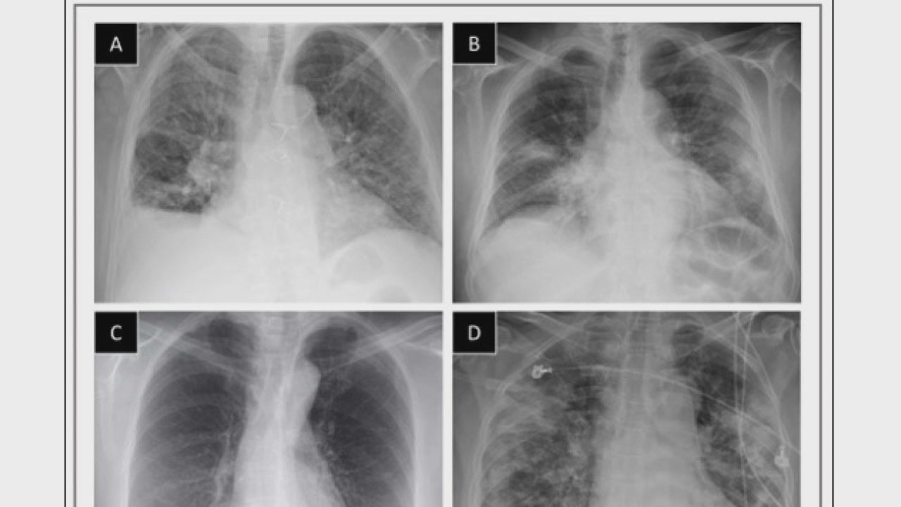 Researchers use artificial intelligence to detect COVID-19 in hospital ... Researchers use artificial intelligence to detect COVID-19 in hospital ...