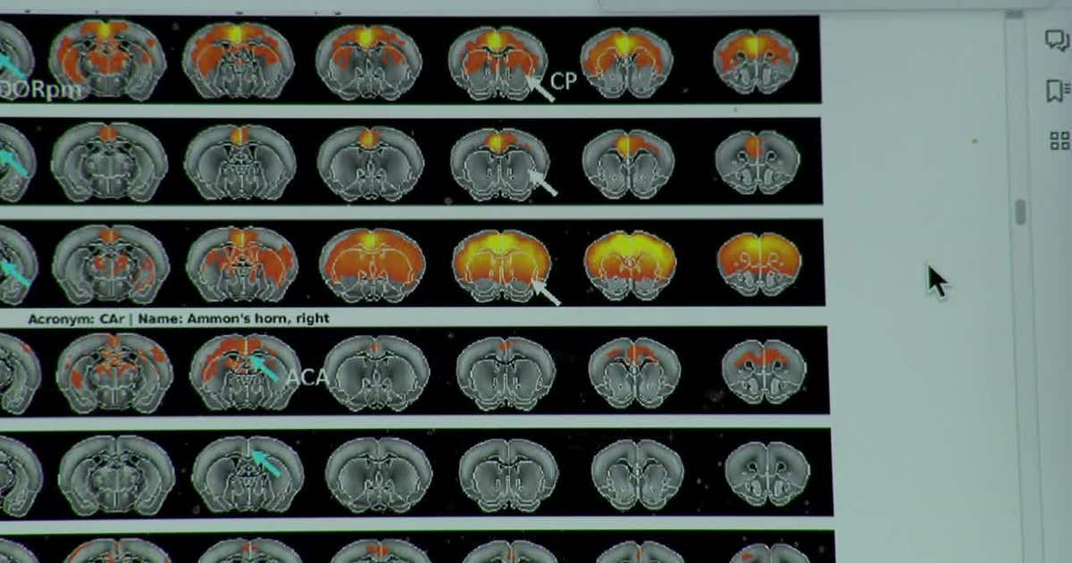 University of Minnesota medical breakthrough in treating childhood ...