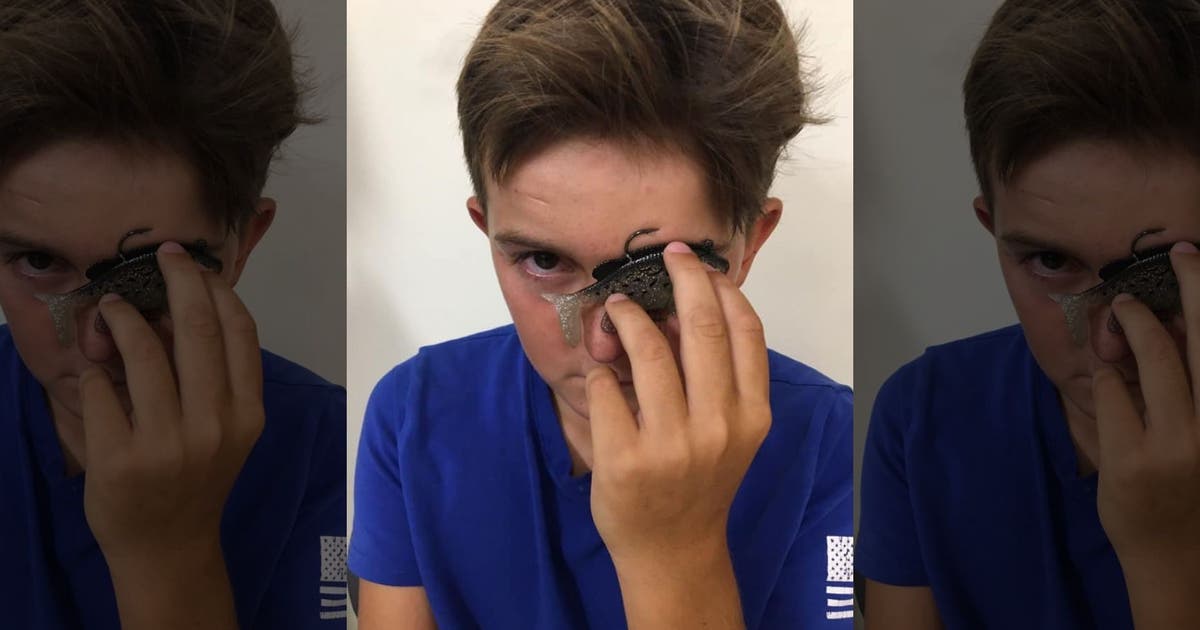 Fishing accident leaves 11-year-old with hook in his eyelid | FOX 11 ...