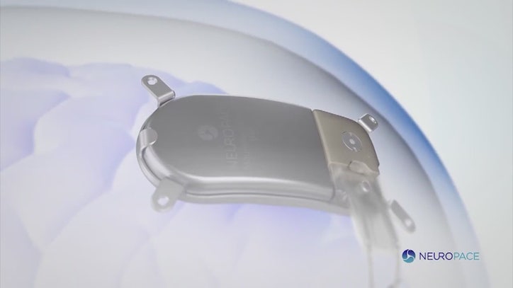 New 'RNS System' device can help millions affected by epilepsy | FOX 11 ...