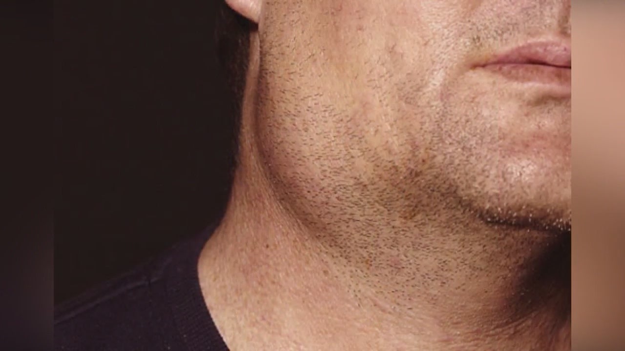 Mumps outbreak declared in Los Angeles County after more than 40 cases ...