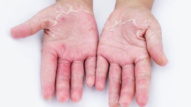 Remedies to help cure the dryness caused by hand-washing, sanitizing ...