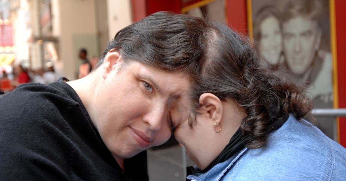 Lori and George Schappell, world's oldest conjoined twins, die at 62 ...