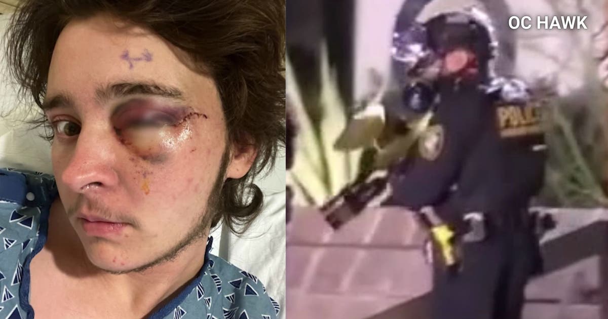 Man speaks out after losing sight in one eye during anti-ICE protest in ...
