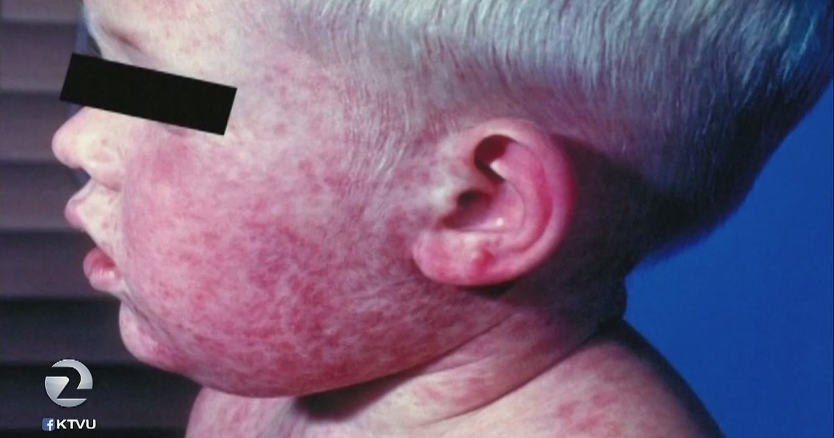 Measles cases up in California, spread by overseas travel | KTVU FOX 2