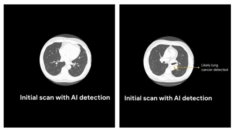 Google AI outperforms radiologists at lung cancer detection | KTVU FOX 2 Google AI outperforms radiologists at lung cancer detection | KTVU FOX 2