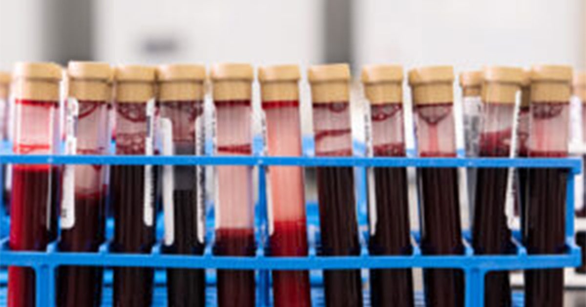 Groundbreaking blood test can detect more than 50 cancers, Bay Area ...