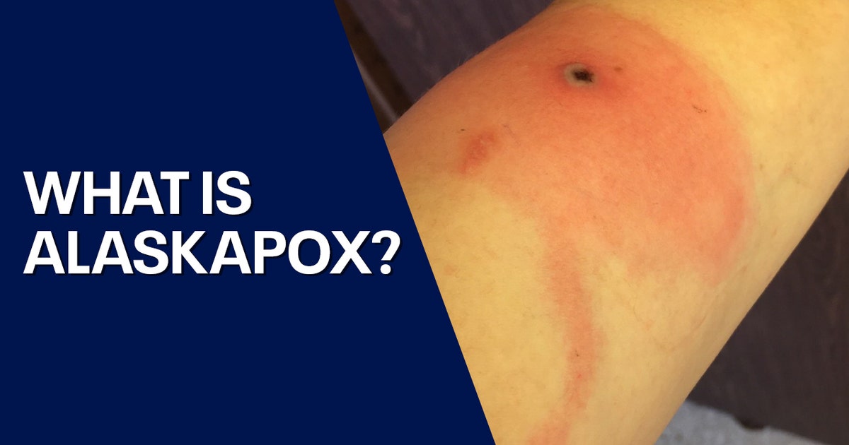 What is Alaskapox? 1st known deadly case reported | LiveNOW from FOX