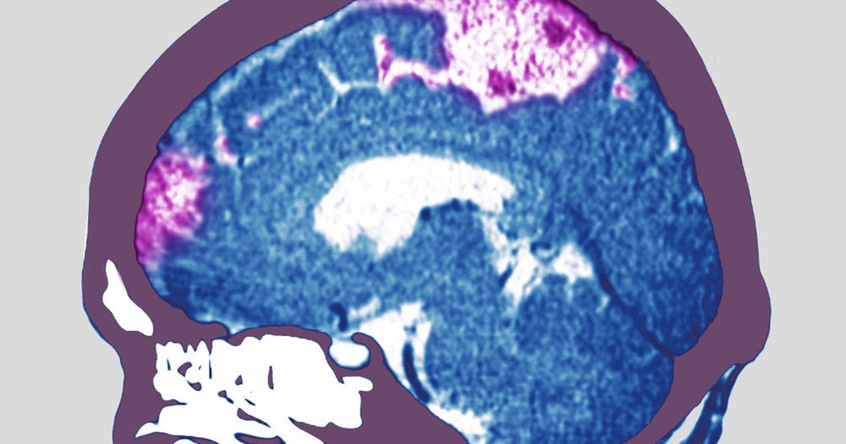 New stroke prevention guidelines released by American Stroke ...
