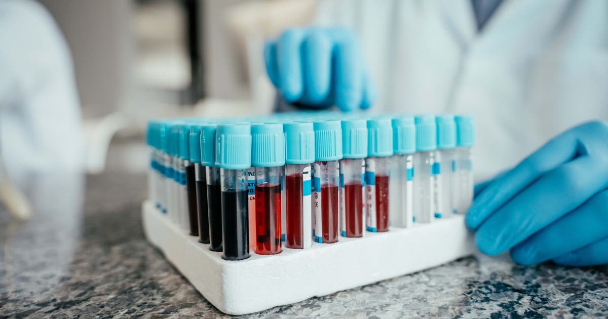 New blood test can detect early signs of ALS, study finds | FOX 4 ...