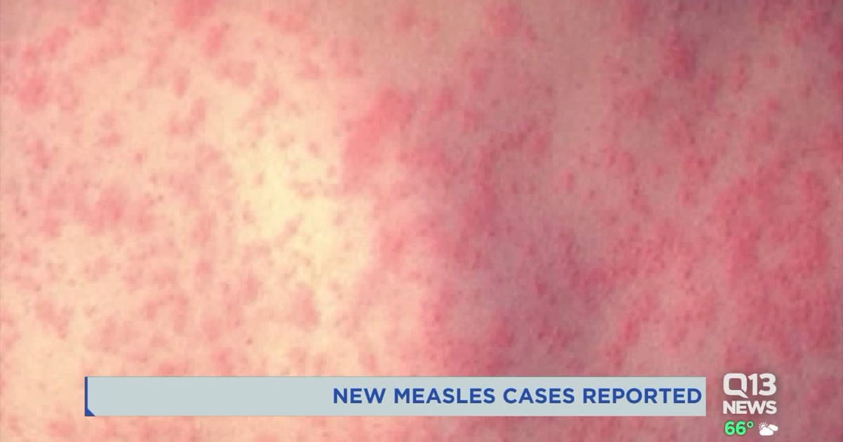 Four new measles cases diagnosed in western Washington | FOX 13 Seattle