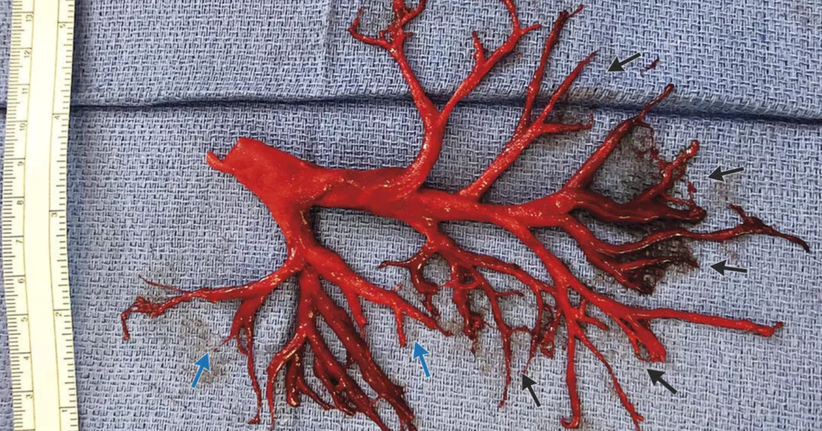 Man dying from heart failure coughs up blood clot shaped like lung ...