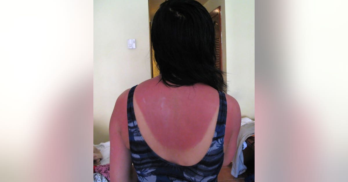 Hot advice from experts on handling a sunburn | FOX 13 Seattle